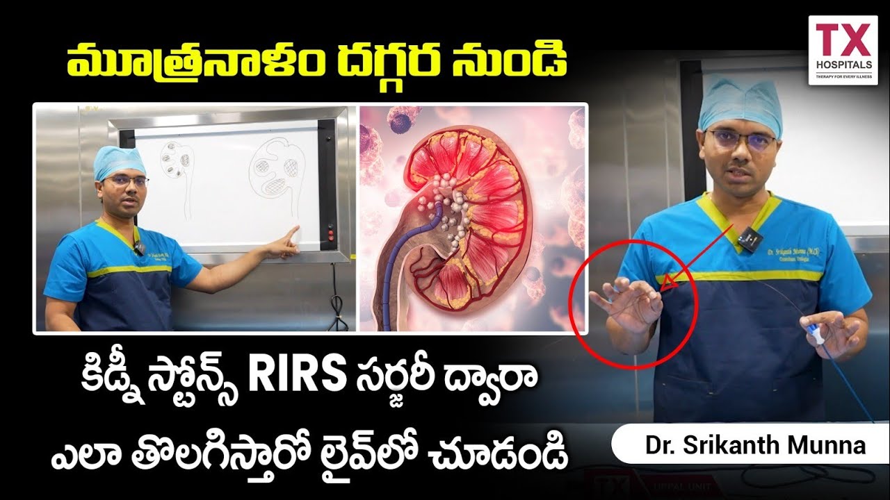 కిడ్నీ స్టోన్స్ RIRS సర్జరీ | RIRS Surgery For Kidney Stone | Kidney ...