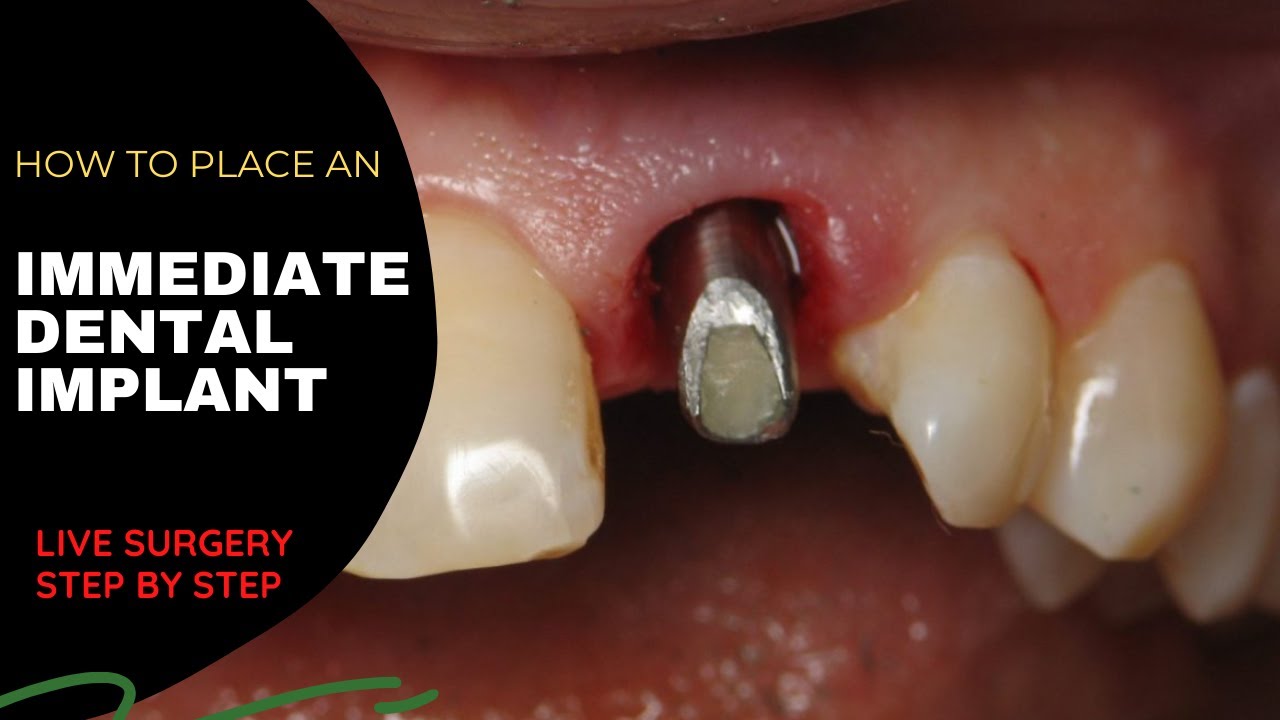 How is an immediate dental implant surgery done? #implants - YouTube
