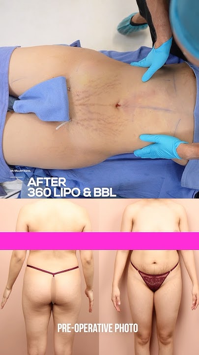 Transformation: Stunning Results of 360 Liposuction And Brazilian Butt Lift (bbl) - YouTube