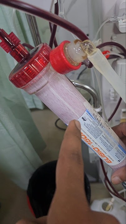 dialyzer findings / capillary occlusion external findinh 🌟 - YouTube