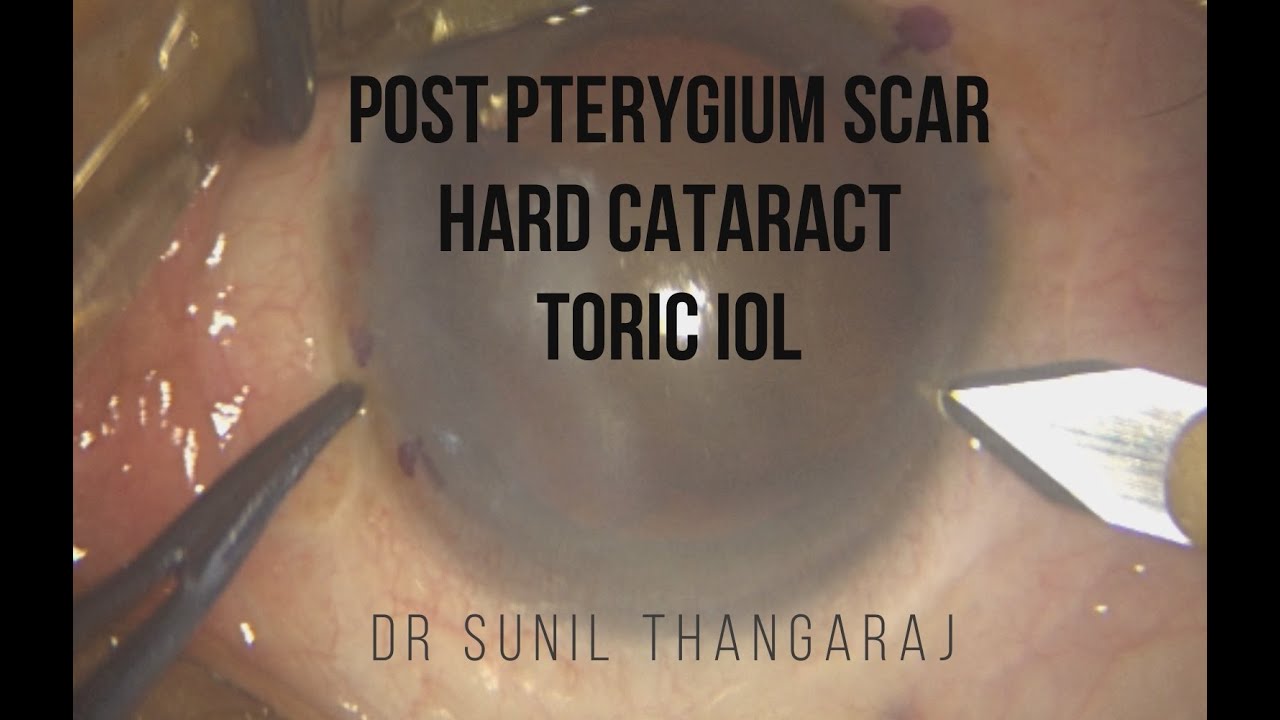 Placing A Toric Iol In A Case Of Post Pterygium Surgical Corneal placing-a-toric-iol-in-a-case-of-post-pterygium-surgical-corneal