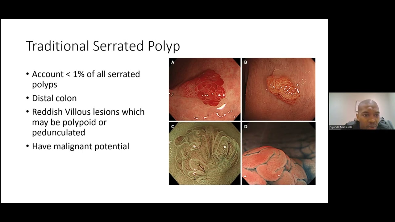 Serrated Polyposis Syndrome