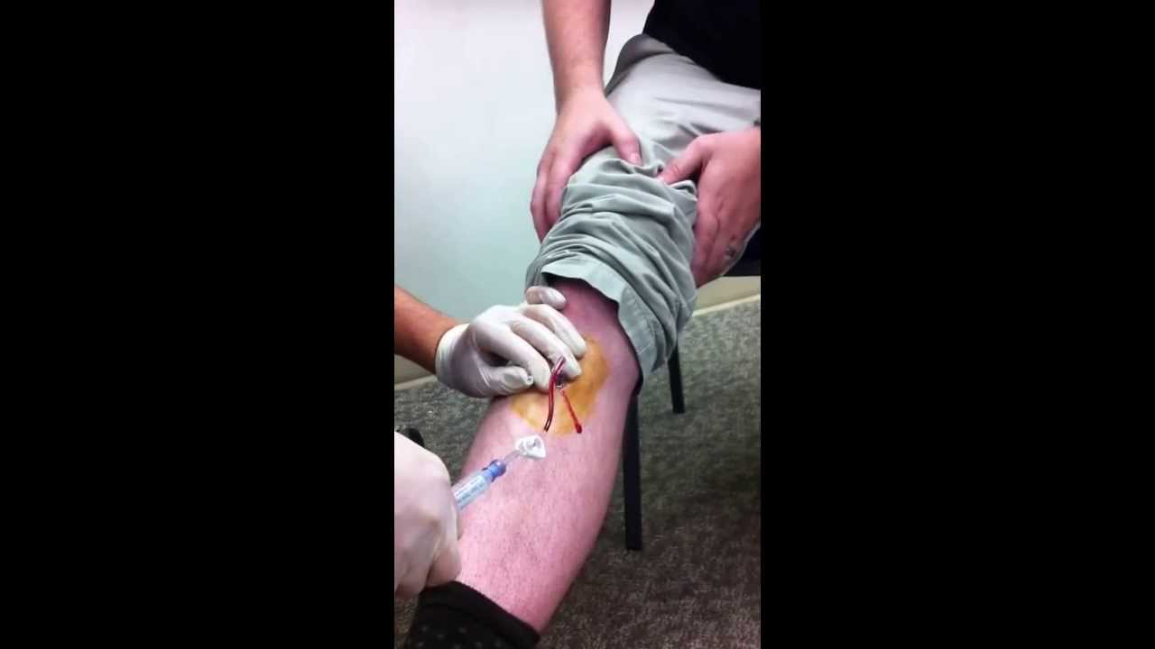 Intraosseous Demonstration YouTube
