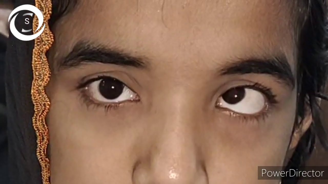 Pre and Post op Congenital alternative squint - YouTube