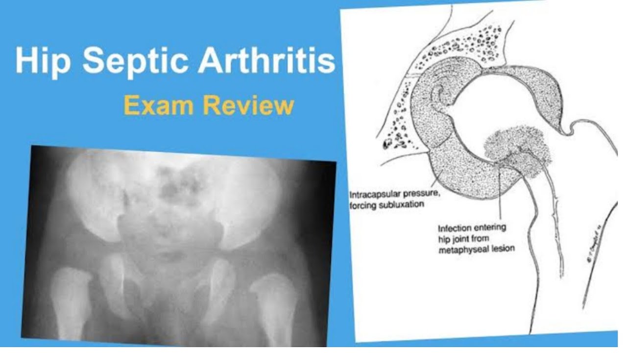 Septic arthritis of right hip joint with bony erosion/ destruction ...