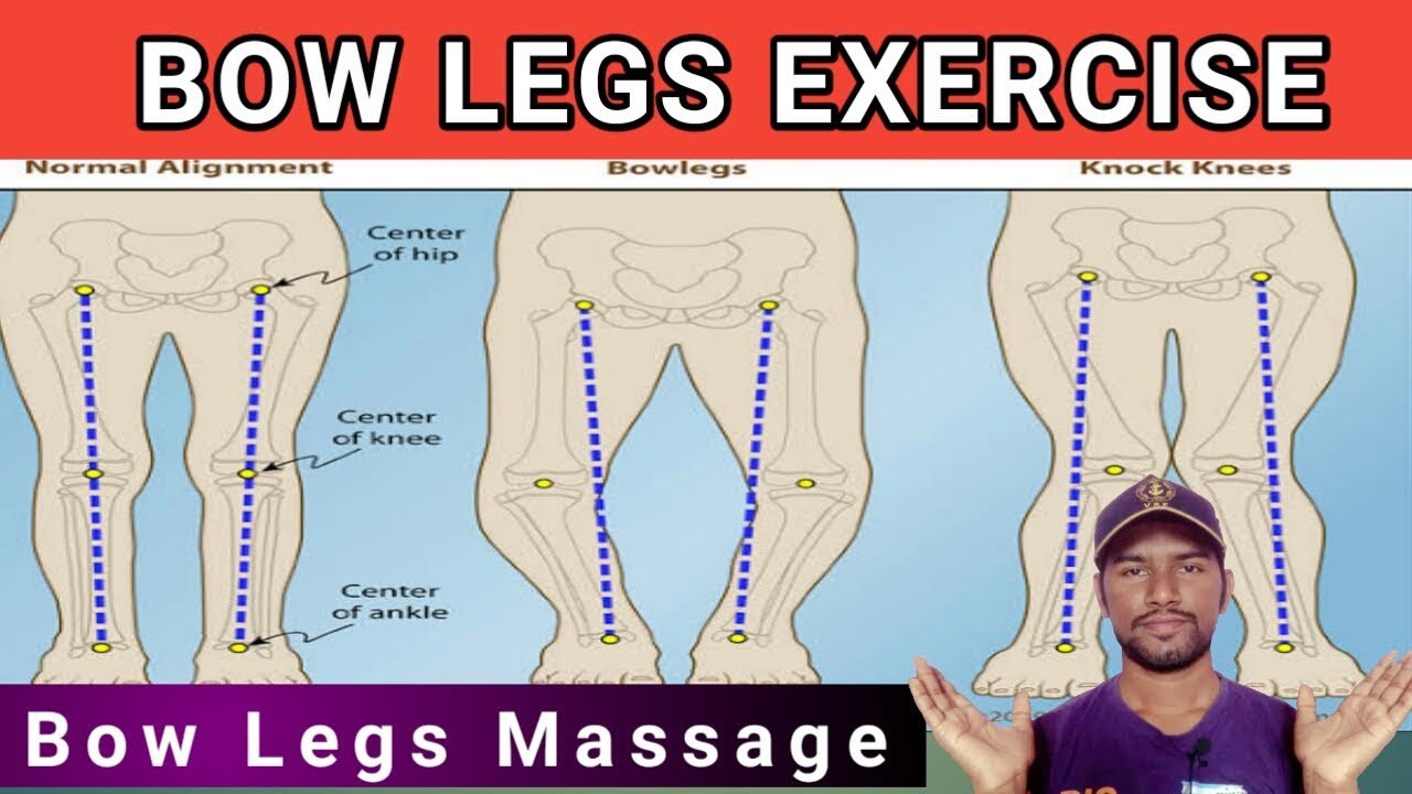 Bow legs correction exercise (घुटनों के दोष से छुटकारा) - YouTube