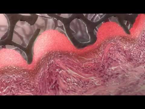 Como funciona la Terapia V.A.C - YouTube