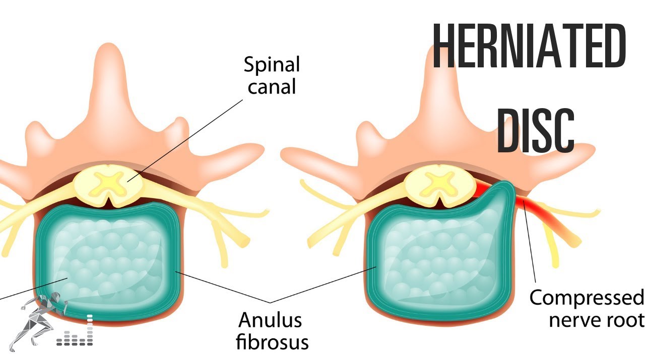 Lumbar herniated disc: What is this back injury, and how can you get ...