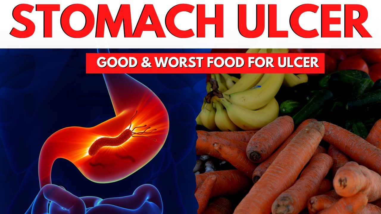 Ulcer Sa Tiyan: Mga Tama At Maling Pagkain Kapag May Ulcer | Tips Para ...