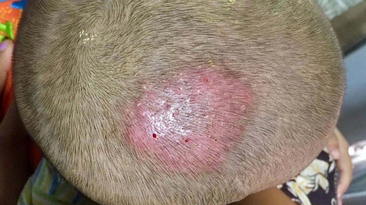 Scalp Dermatophytosis with Abscess Formation - YouTube