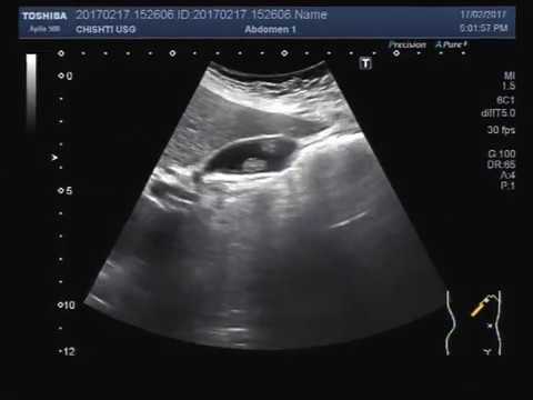 Ultrasound Video showing two Sludge Balls in the Gall Bladder. - YouTube