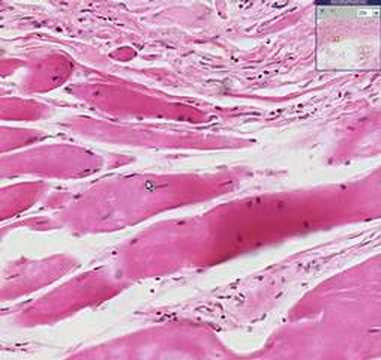 Histopathology Skeletal muscle -- Muscular dystrophy - YouTube