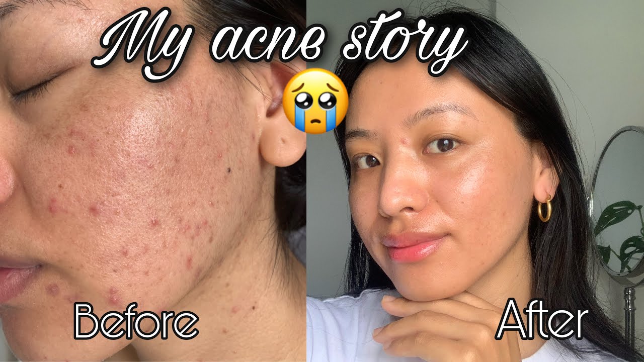 My acne story(How I cleared up my acne) | My morning skincare routine ...
