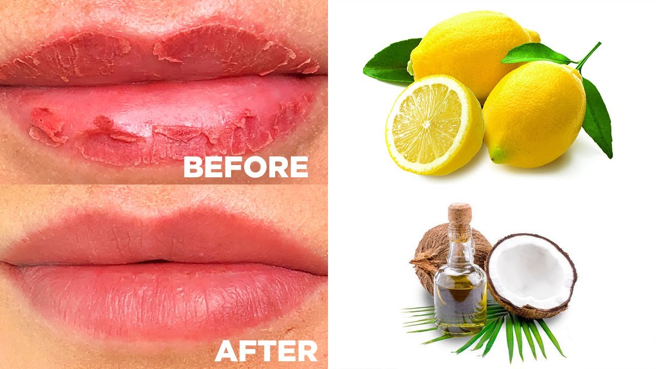 Easy Way to Protect Your Lips from COLD - Winter Dry Lips | Prinsha ...