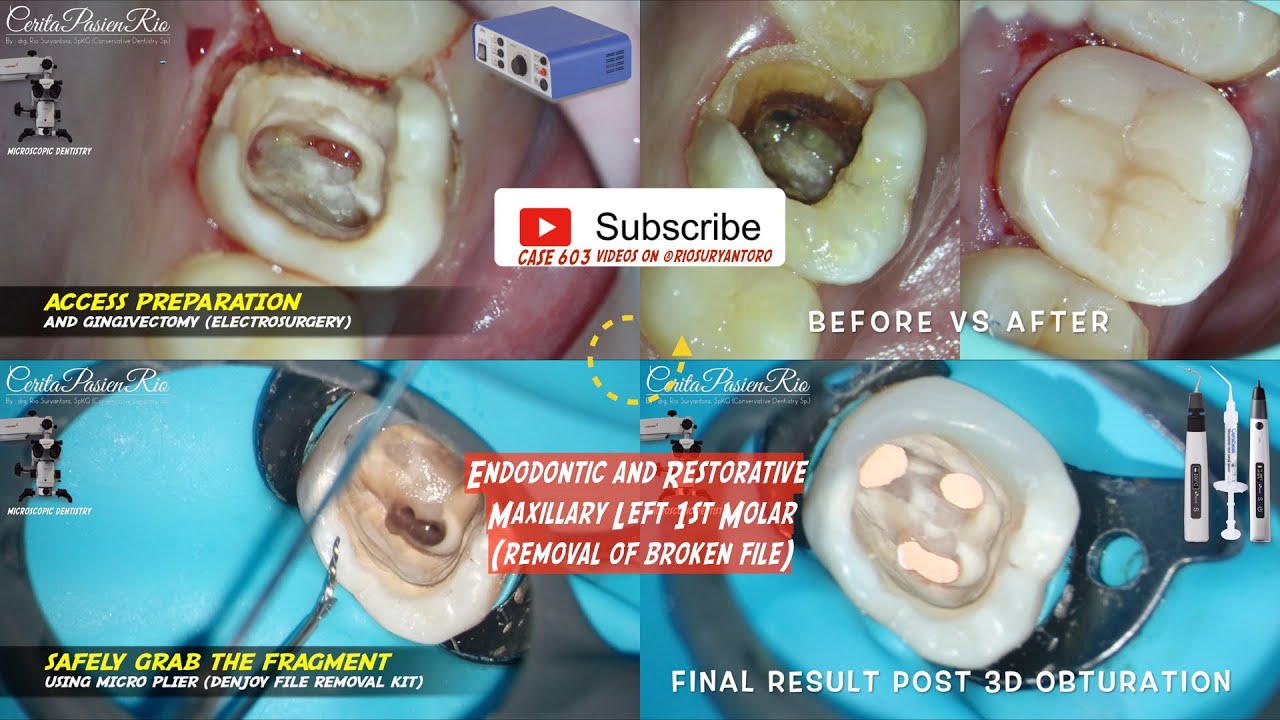 ONE VISIT ENDO & INTERMEDIATE RESTORATION IN 2ND VISIT - REMOVAL OF ...