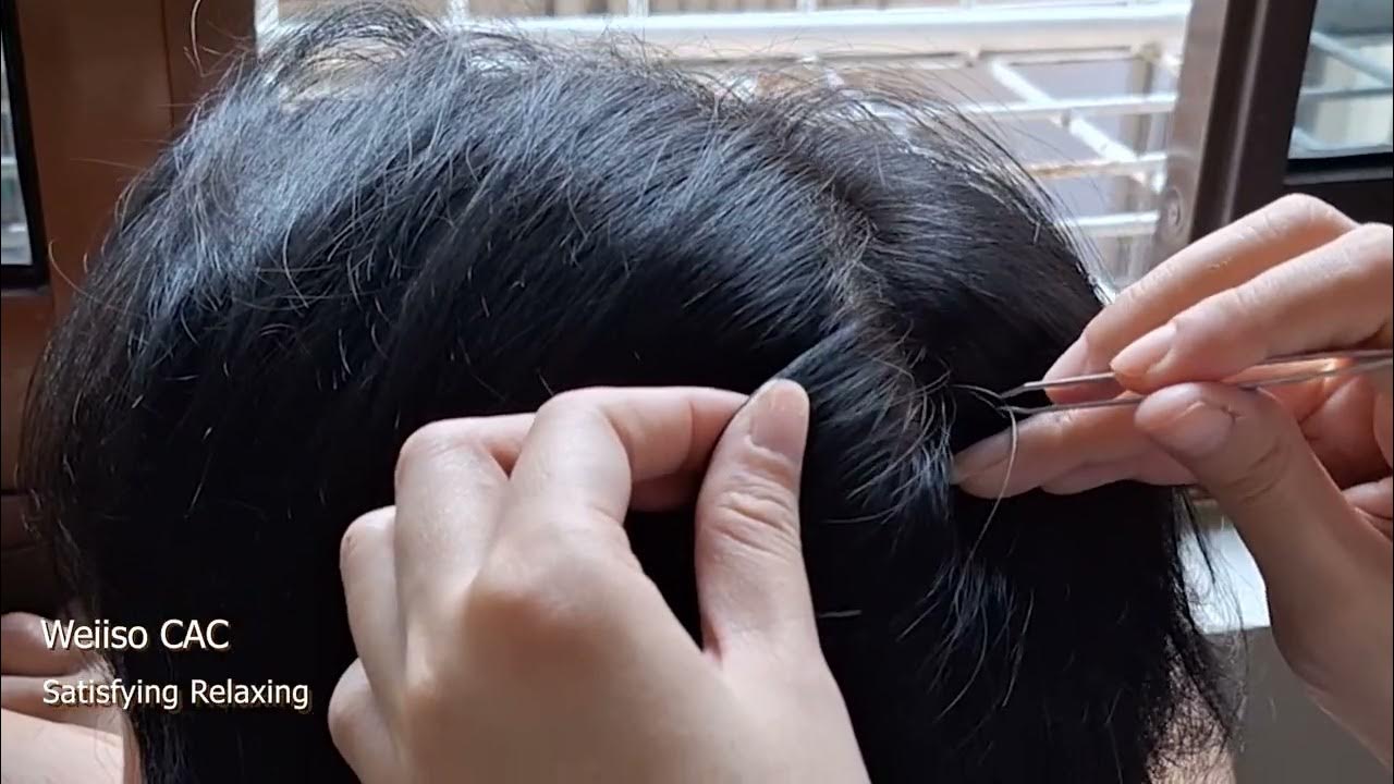 Satisfying Relaxing Cabut Uban Mamer #12 - YouTube