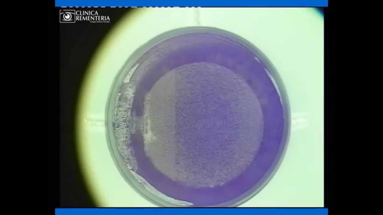 LASIK | creación de flap con láser Femtosegundo WaveLight FS200 | Dr ...