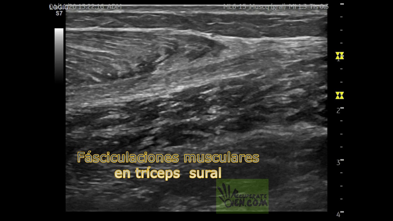 fasciculaciones Triceps sural - YouTube