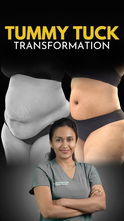 Amazing Tummy Tuck Transformation in Dr. Sunita Aesthetics - YouTube