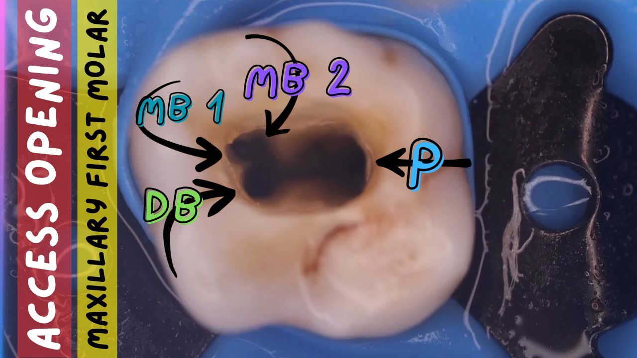 Access Opening ⚪️ Maxillary First Molar 🔵 Detailed Step by Step - YouTube