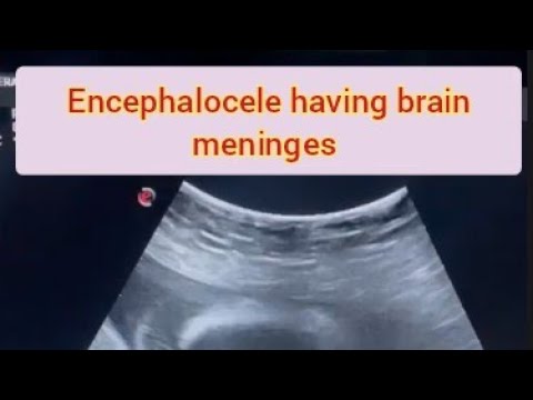 Fetal Encephalocele Ultrasound - YouTube