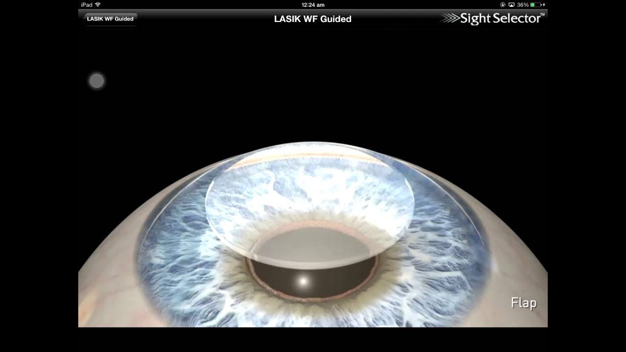 Lasik wavefront guided - YouTube