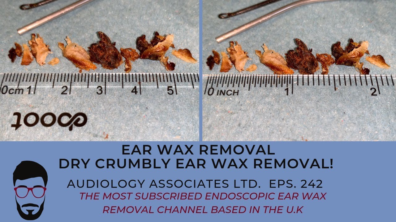 EAR WAX REMOVAL - DRY CRUMBLY EAR WAX REMOVAL - EP 242 - YouTube