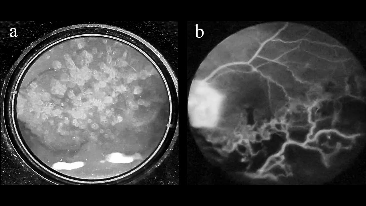 World's first Fluorescein Angioscopy / Angiography on a Smartphone ...