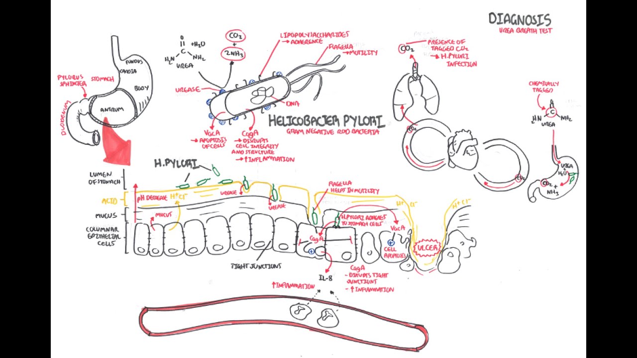 Microbiology Helicobacter Pylori Ulcer YouTube
