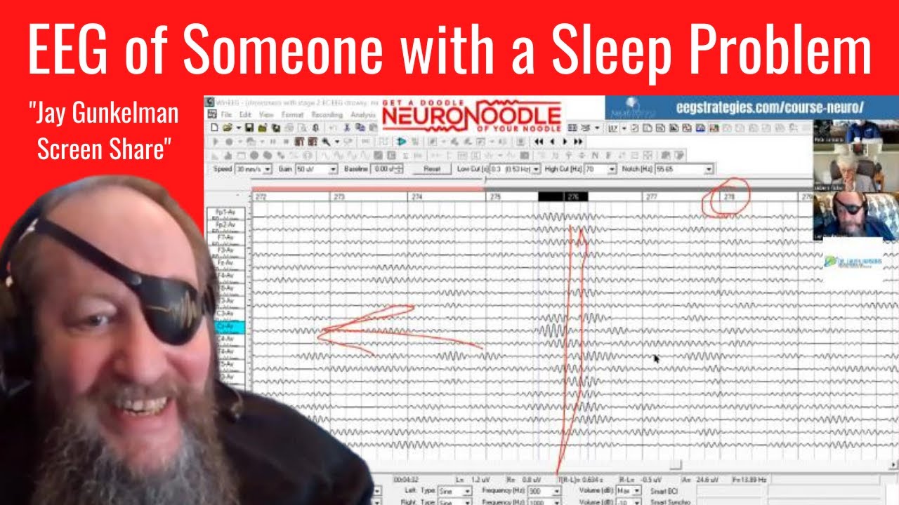 EEG of Someone with a Sleep Problem Jay Gunkelman - YouTube