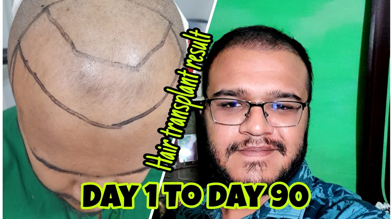 Hair Transplant Result😀 Day 1 To Day 90 💥 Hair Transplant Result