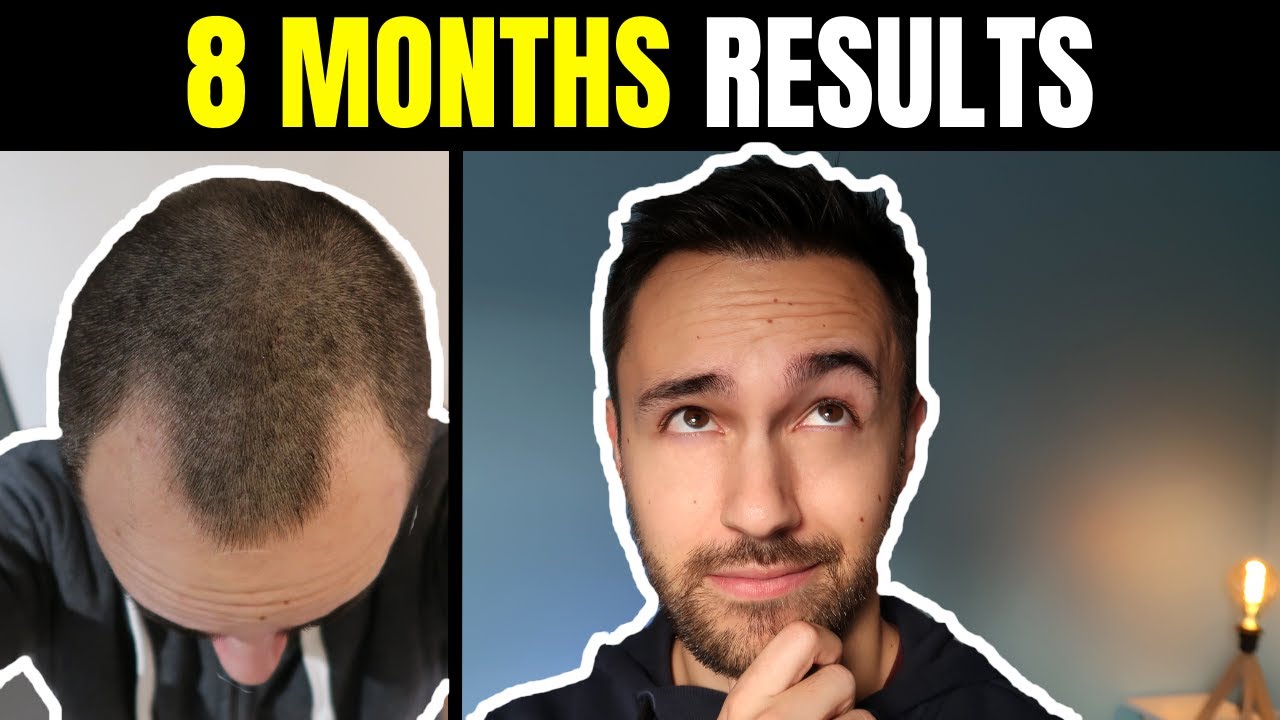 8 Month Update of my Hair Transplant - YouTube