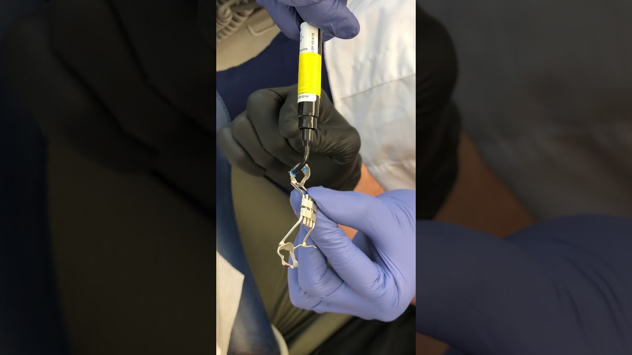 Cementing a laser-sintered RPE - YouTube