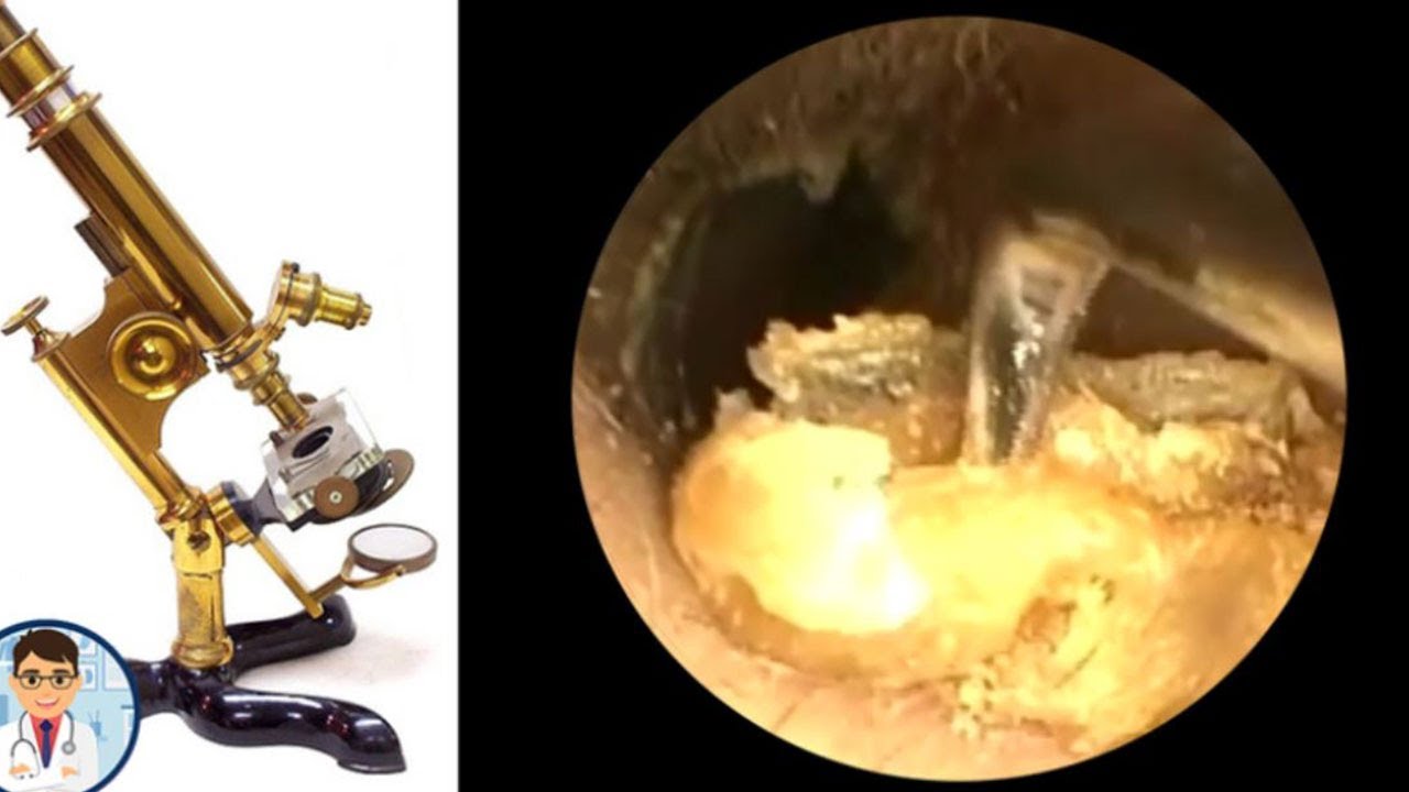ruptured eardrum removal by endoscopic - YouTube