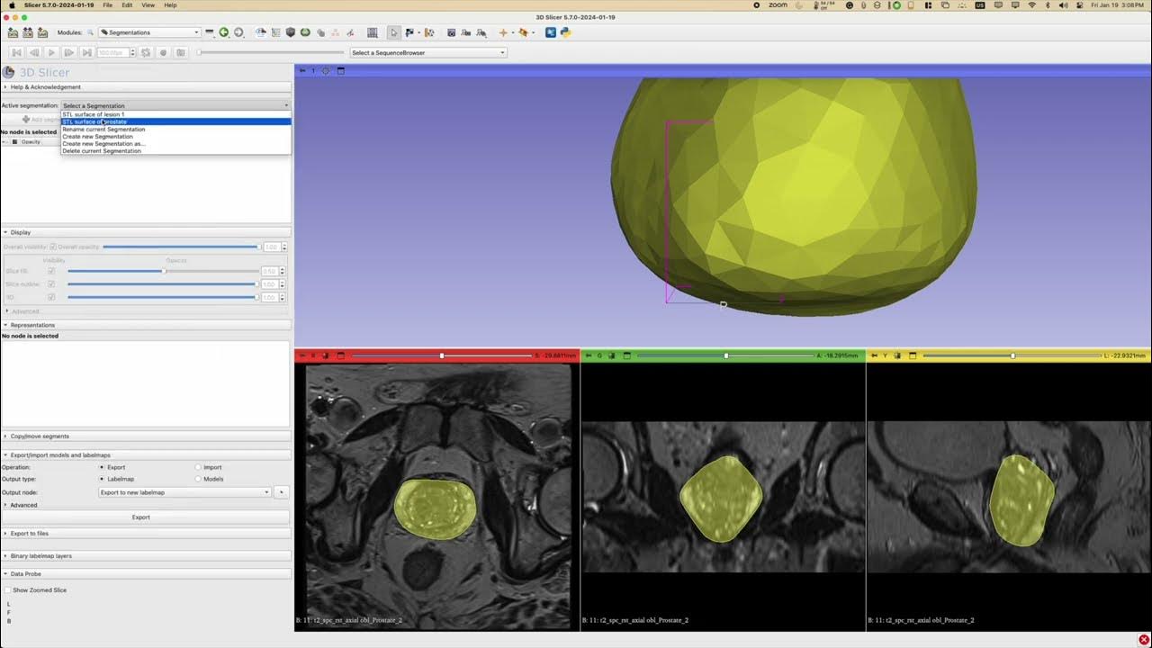 How to open DICOM Encapsulated STL files (M3D) in 3D Slicer - YouTube