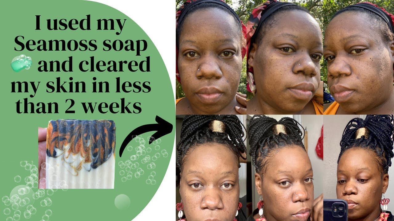 How I cleared my skin in less than 2 weeks. Plus let’s talk about a ...