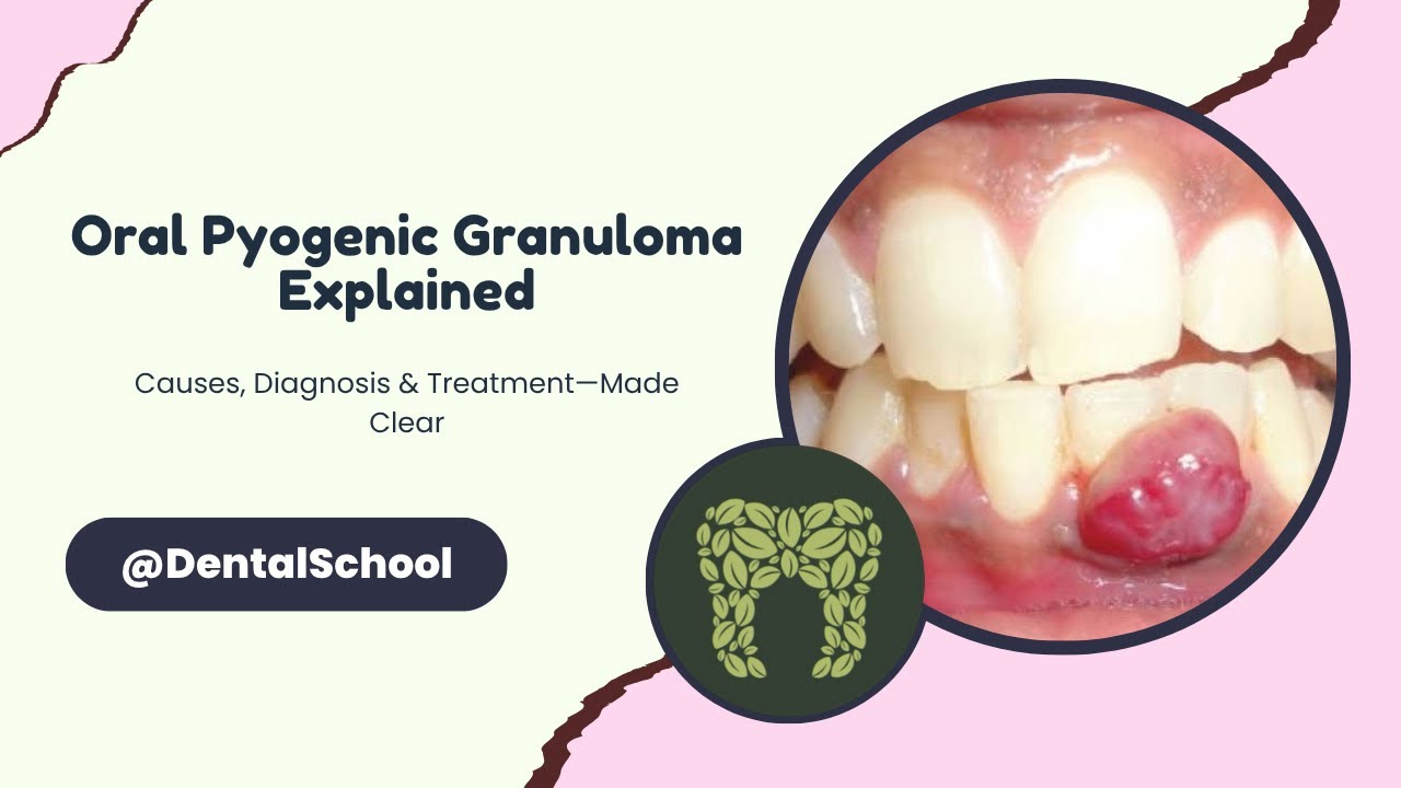 Oral Pyogenic Granuloma: Causes, Appearance, and Clinical Management - YouTube