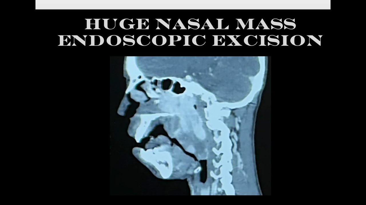 Huge Nasal Mass Endoscopic Excision- Dr. V. Narendrakumar - YouTube