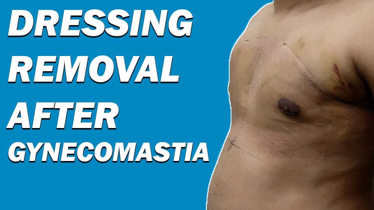 👍Gynecomastia Result !! Dressing Removal !! Dr. Prashant Yadav ...