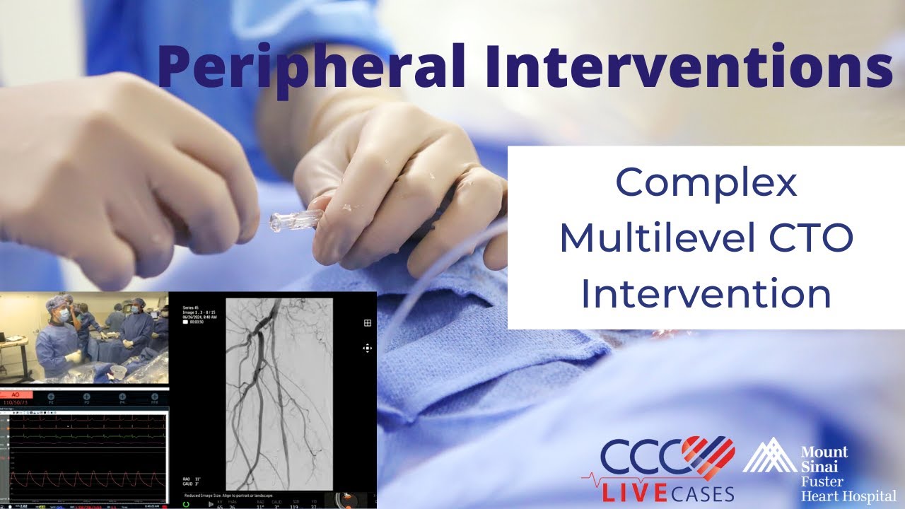 Complex Multilevel CTO Intervention - YouTube