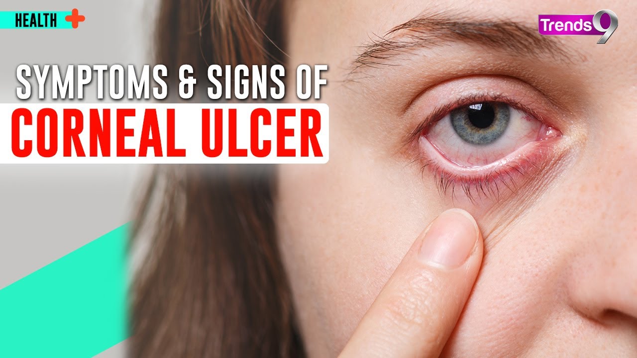 What is Corneal Ulcer? Know Symptoms and Prevention Tips - Watch Video ...