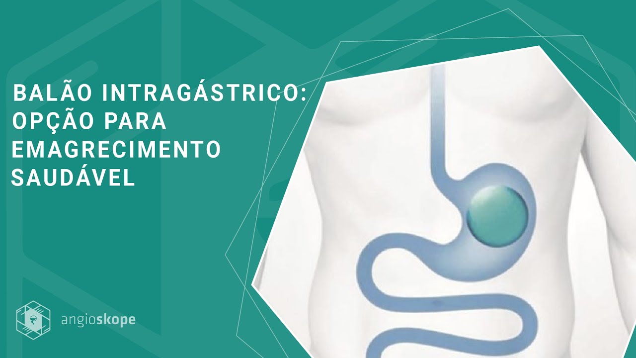 Balão intragástrico: opção para emagrecimento saudável - YouTube