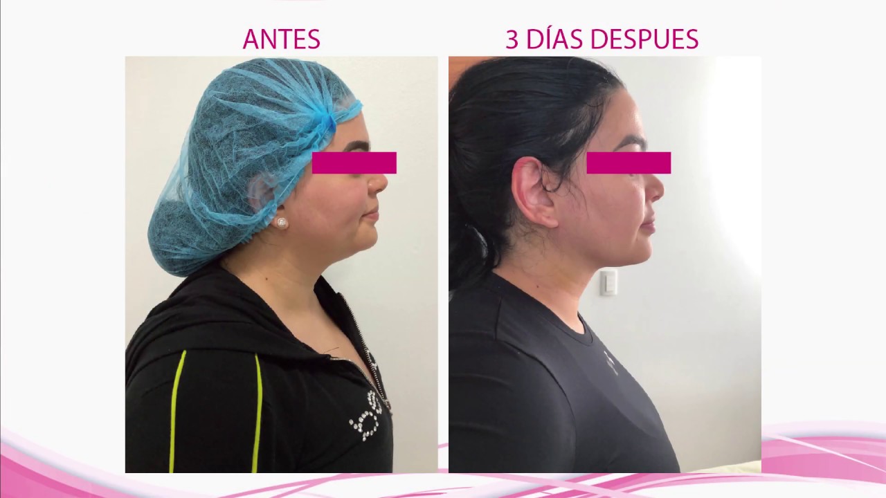 Laserlipolisis en Papada (Increíbles resultados) - YouTube