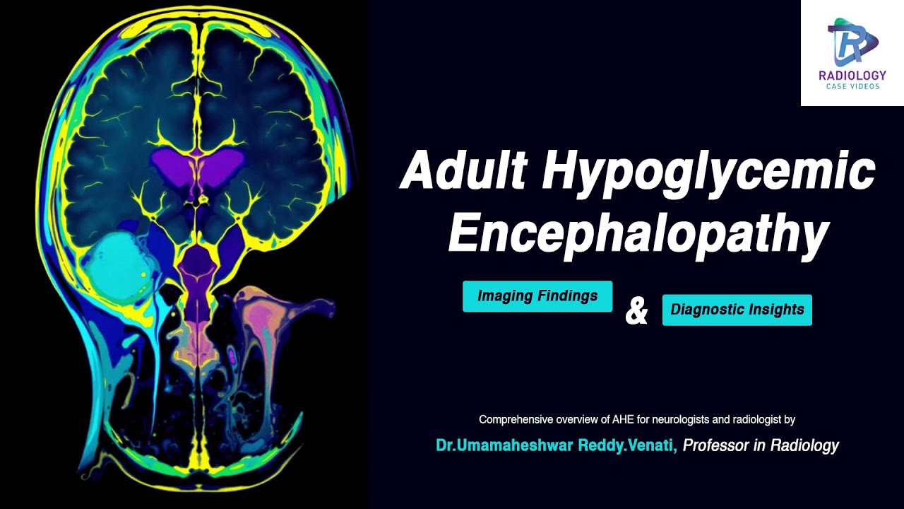 Hypoglycemic Encephalopathy in Adults: Imaging Findings & Diagnosis by ...