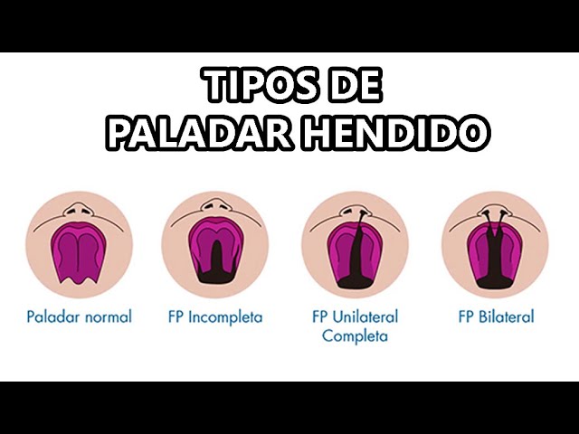 Tipos De Paladar Hendido 1200x1637