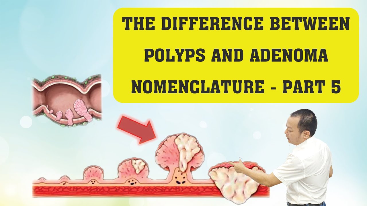 The Difference Between Polyos And Adenoma - Nomenclature - Part 5 # ...
