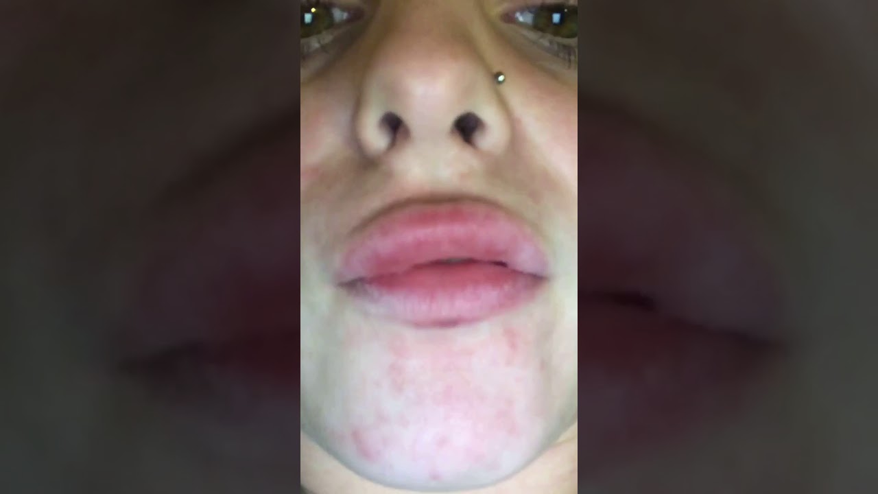 Kylie Jenner Lip Challenge Gone Wrong Youtube