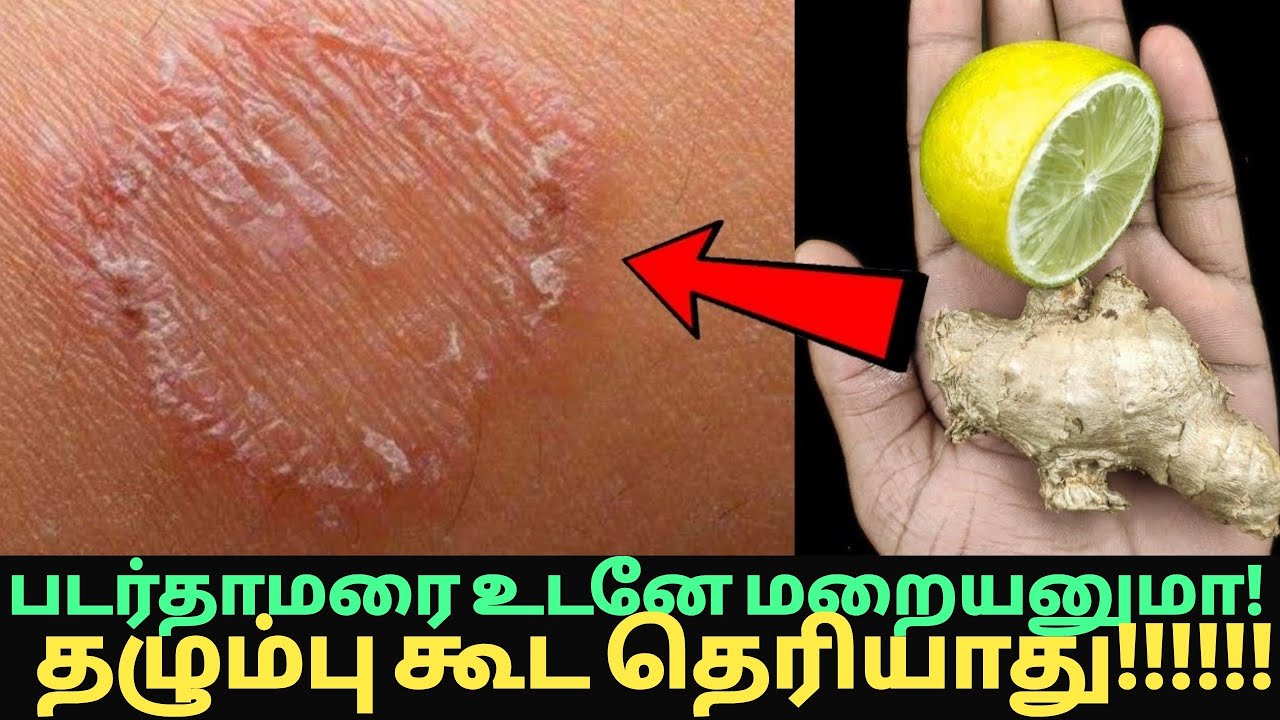 1 மணி நேரத்தில் படர்தாமரை,அரிப்பு,படை காணாமப் போகும்!remedy for ring ...