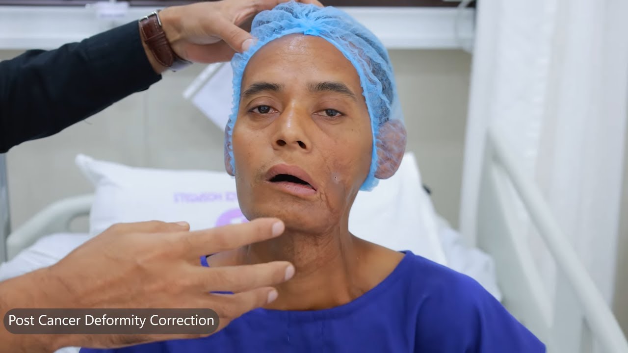 Post Oral Cancer Surgery at Richardson Face Hospital - YouTube