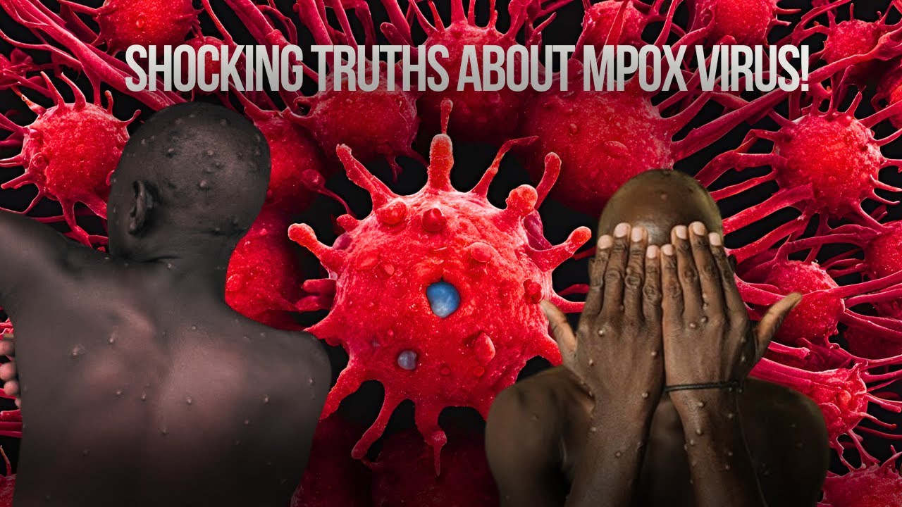 Monkeypox Outbreak 2024: Symptoms, Prevention, & Updates! - YouTube